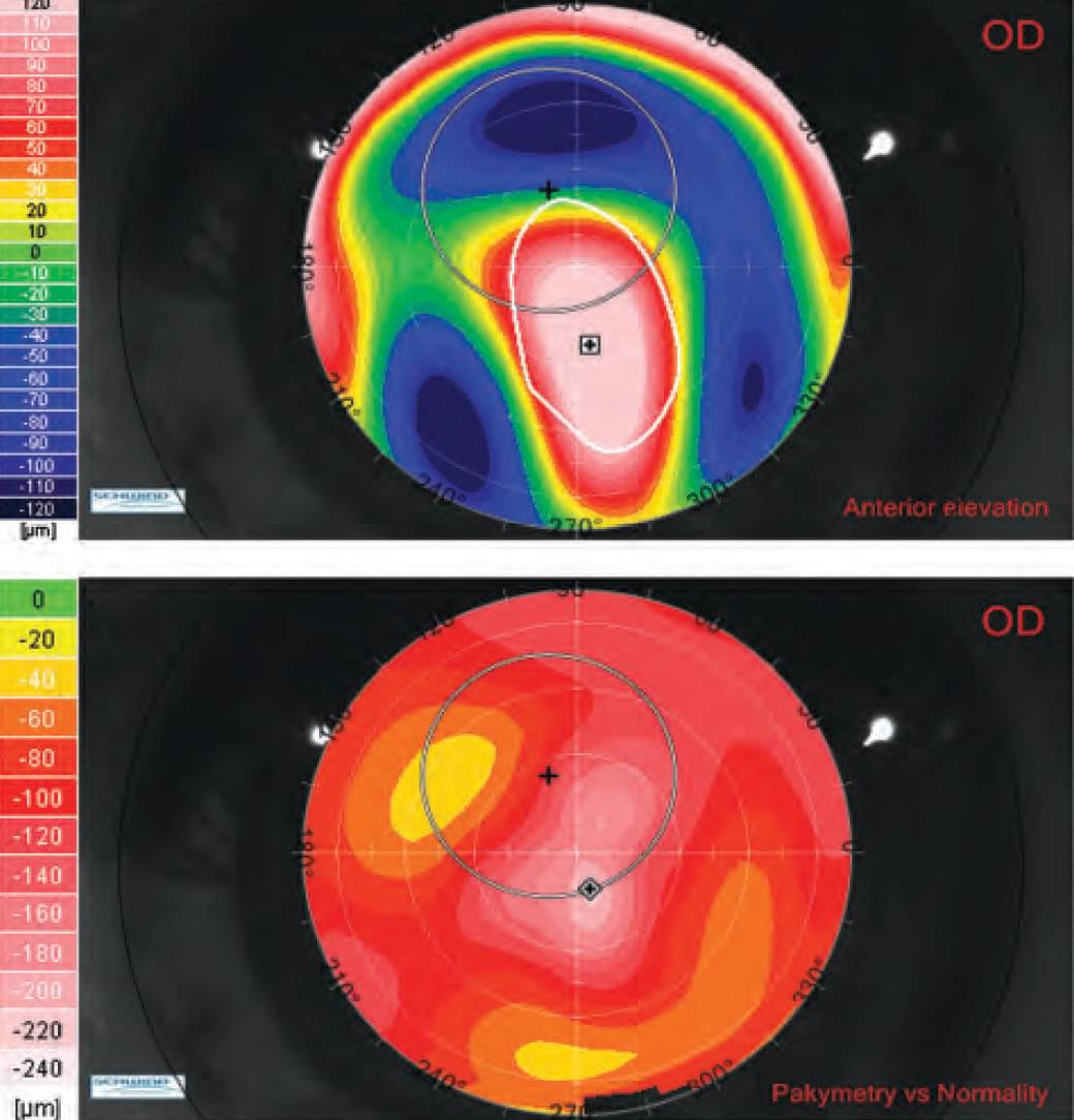 Schwind Sirius - Cornea Medical