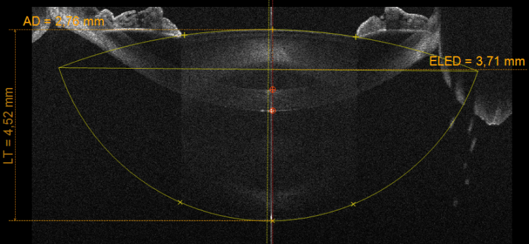 CSO MS39 - Cornea Medical