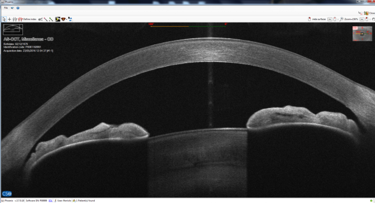 CSO MS39 - Cornea Medical